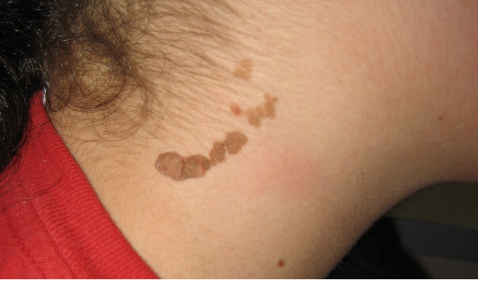 An Atlas of Lumps and Bumps, Part 32: Linear Epidermal Nevus | Consultant360